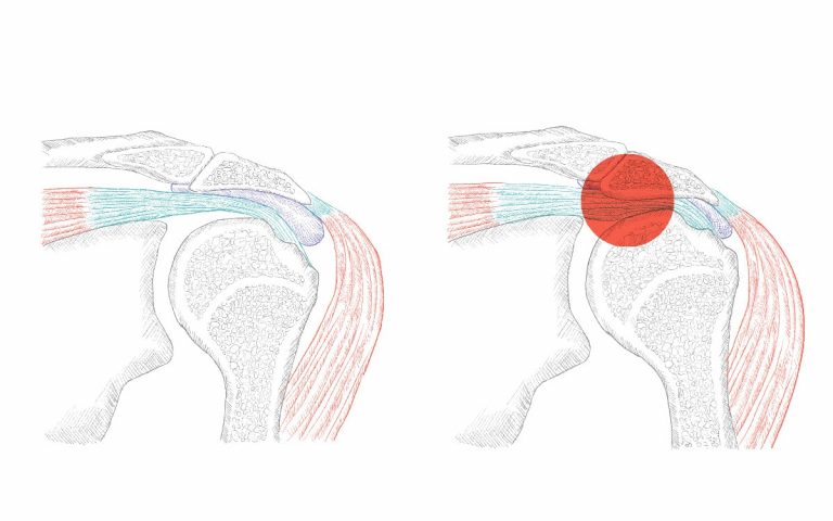 Conflito Subacromial – Ortopedistas